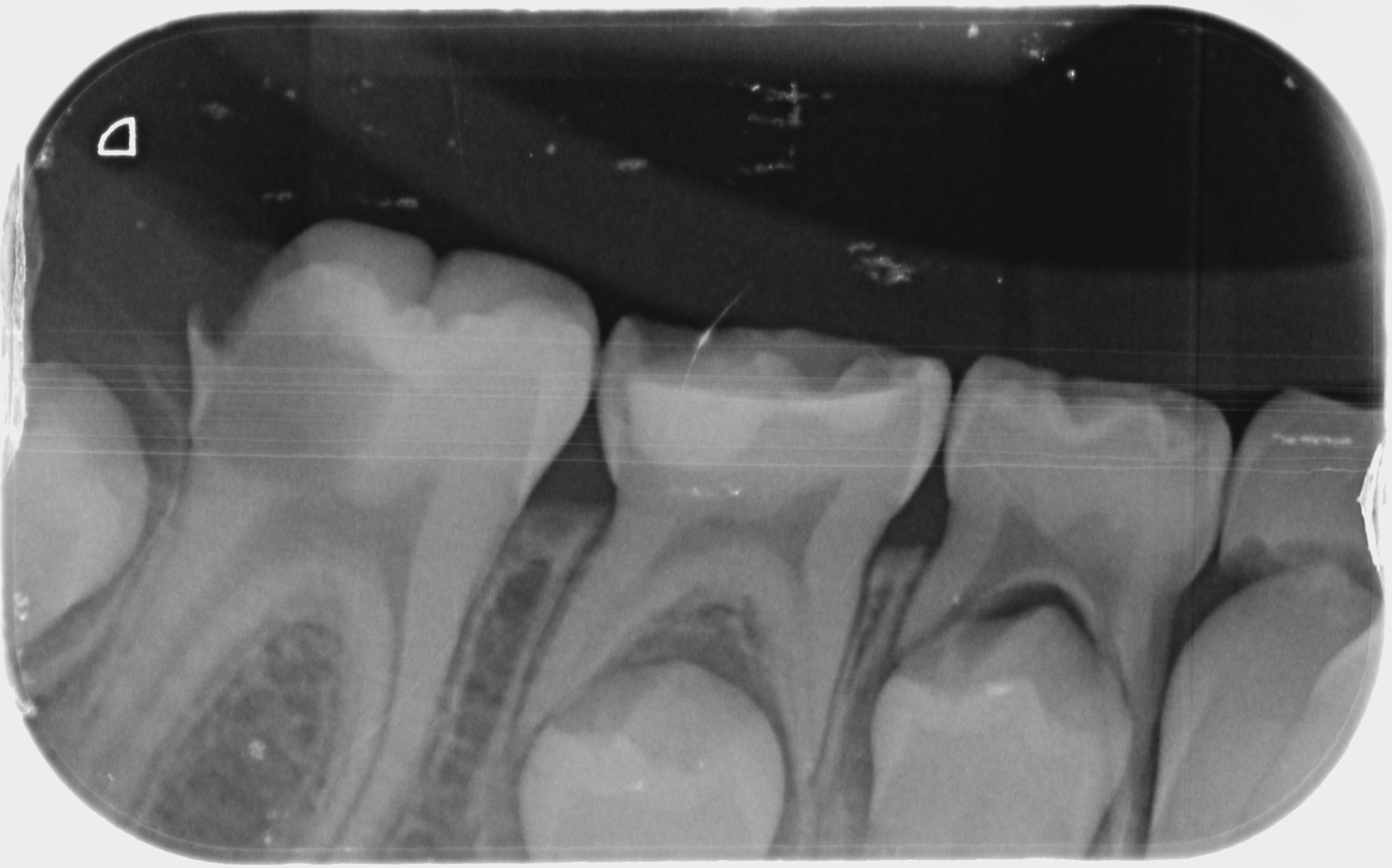 Comment faire une pulpotomie chez l'enfant